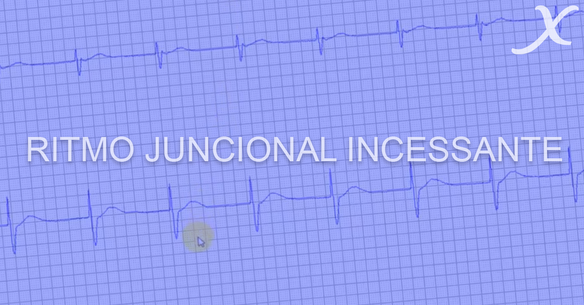 Ritmo Juncional Incessante - TME - Telemedicina Cardiológica