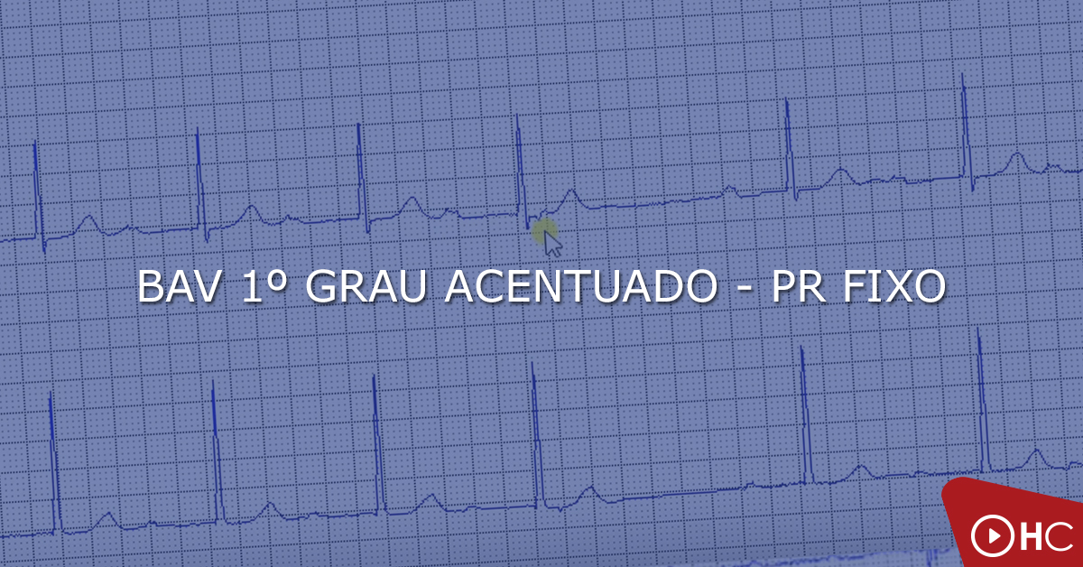 BAV 1º GRAU ACENTUADO – PR FIXO - TME - Telemedicina Cardiológica