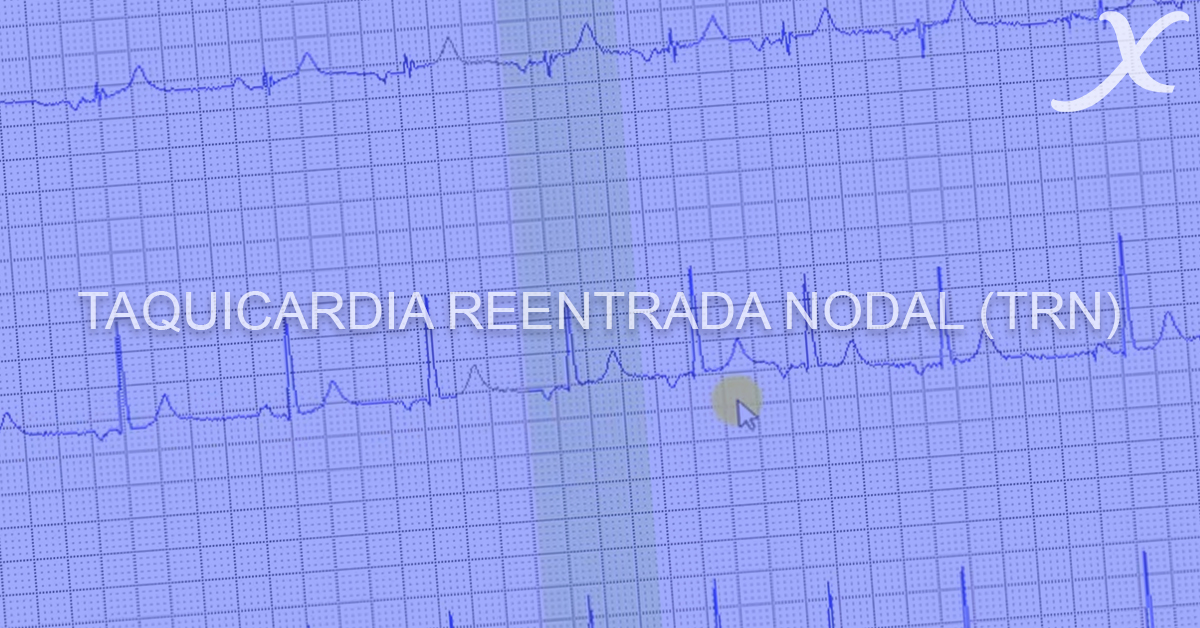 TAQUICARDIA REENTRADA NODAL (TRN) - TME - Telemedicina Cardiológica