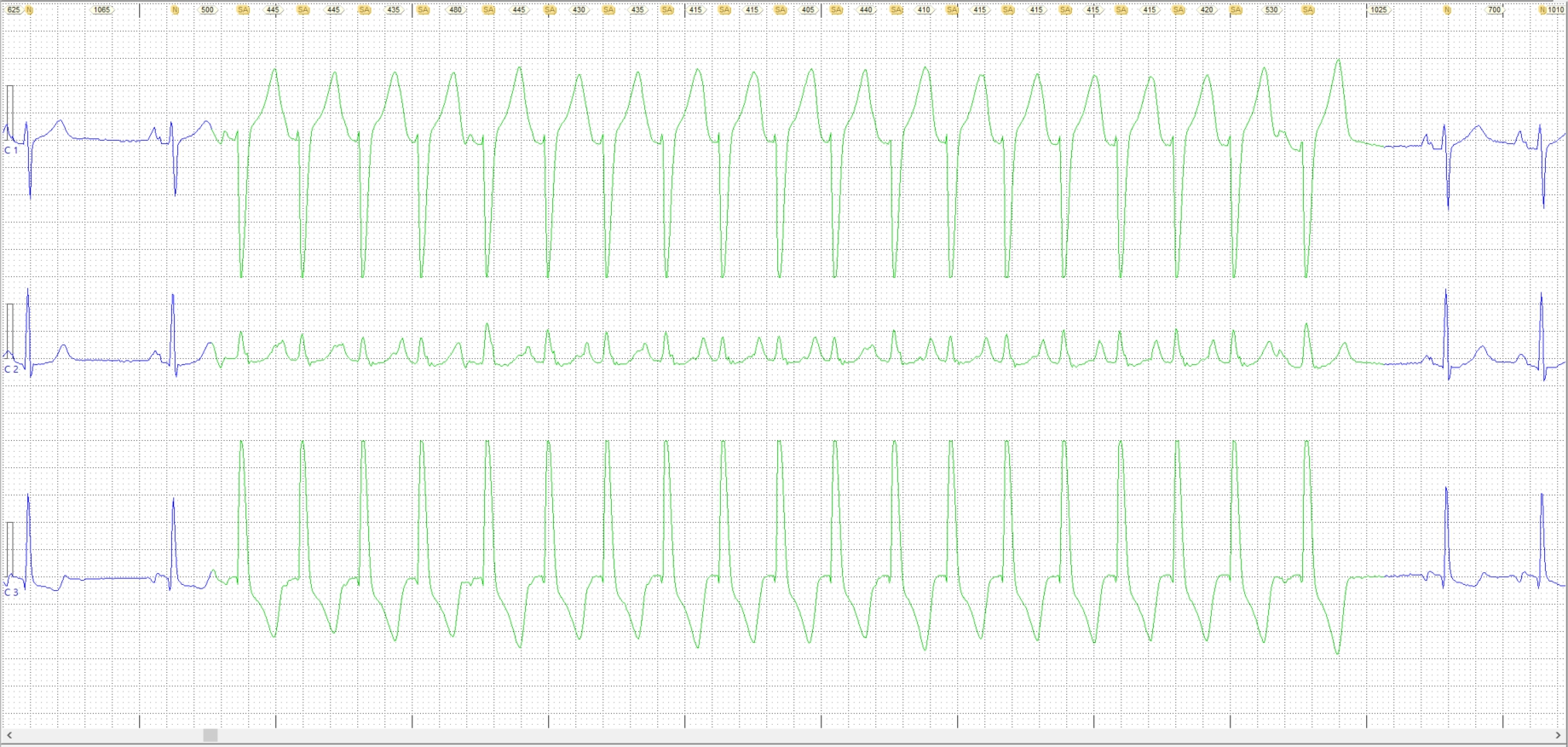 Taquicardia Atrial (TA) aberrante - TME - Telemedicina Cardiológica