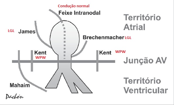 Mahaim Pré-excitação Ventricular - TME - Telemedicina Cardiológica