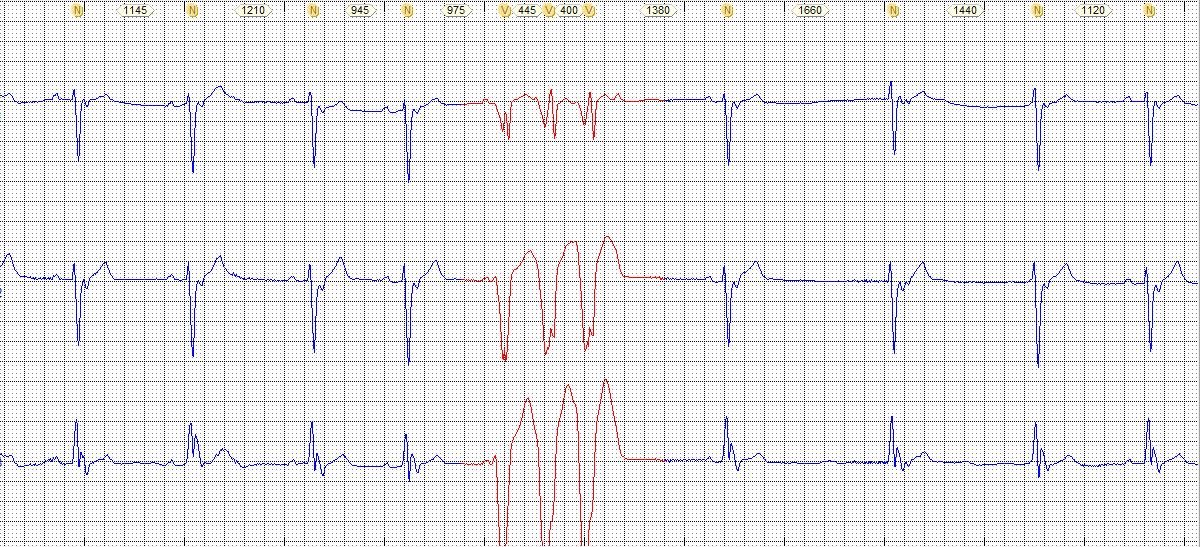 Josephson's sign - TME - Telemedicina Cardiológica