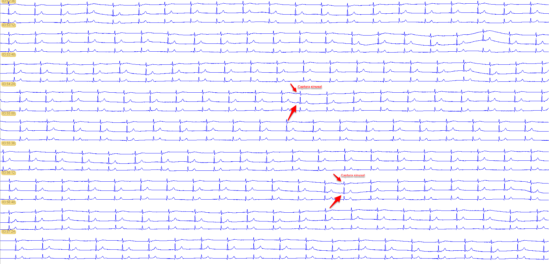 Ritmo Juncional Acelerado