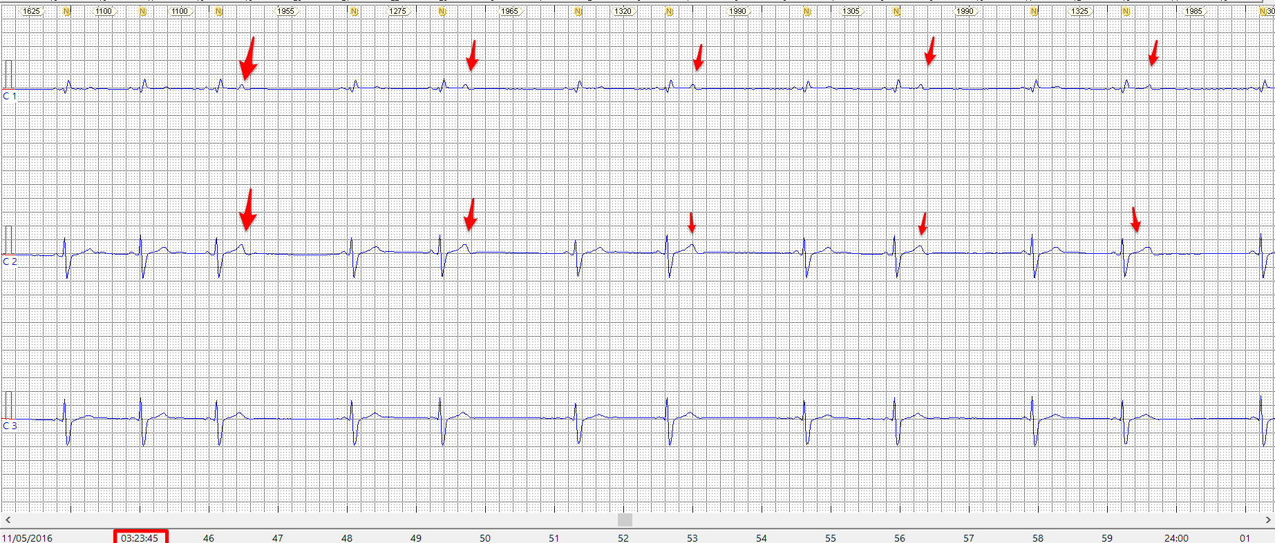 Bigeminismo Ventricular PAROXYSMAL VENTRICULAR STANDSTILL