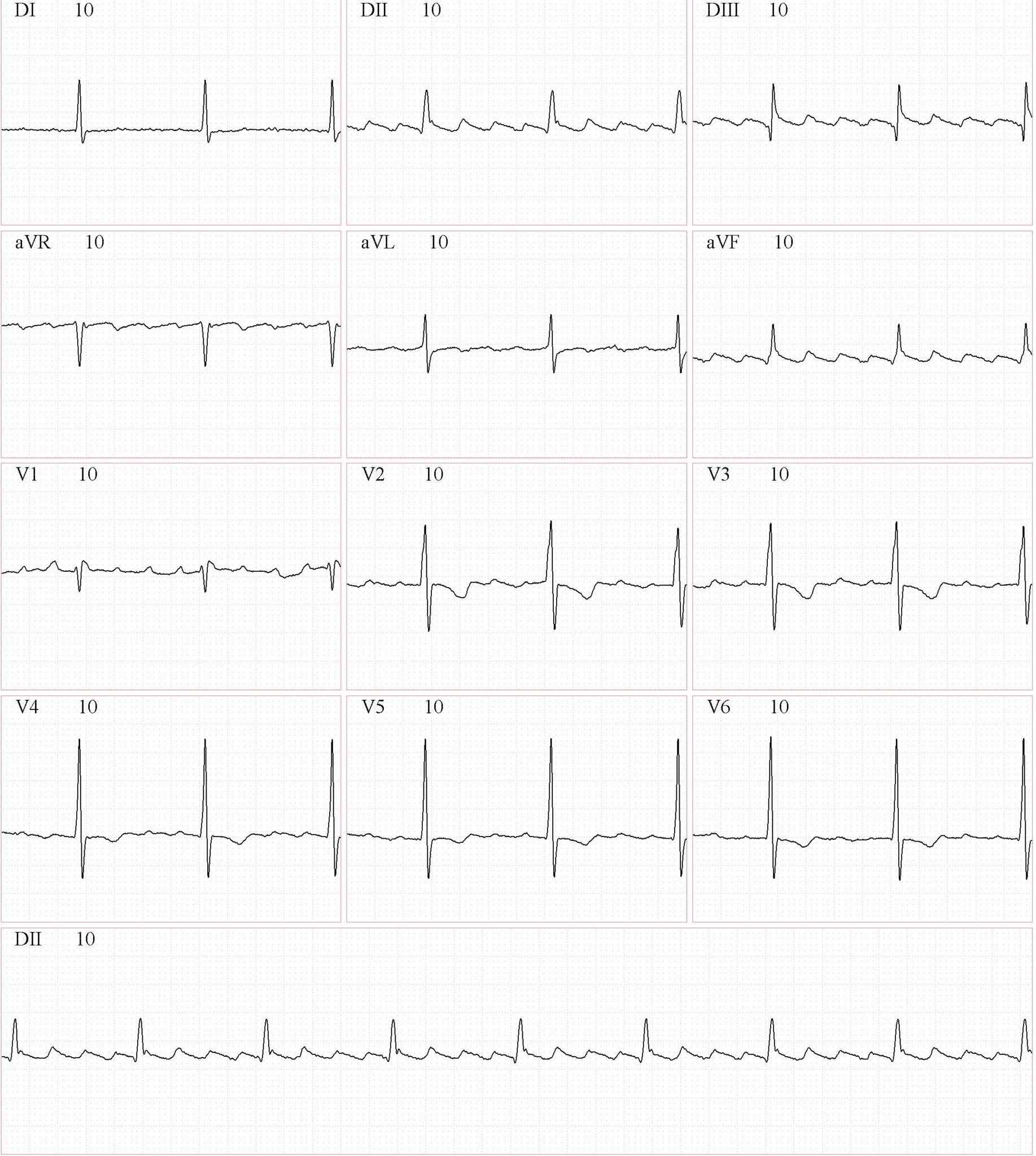 Flutter em 12 Derivações - TME - Telemedicina Cardiológica