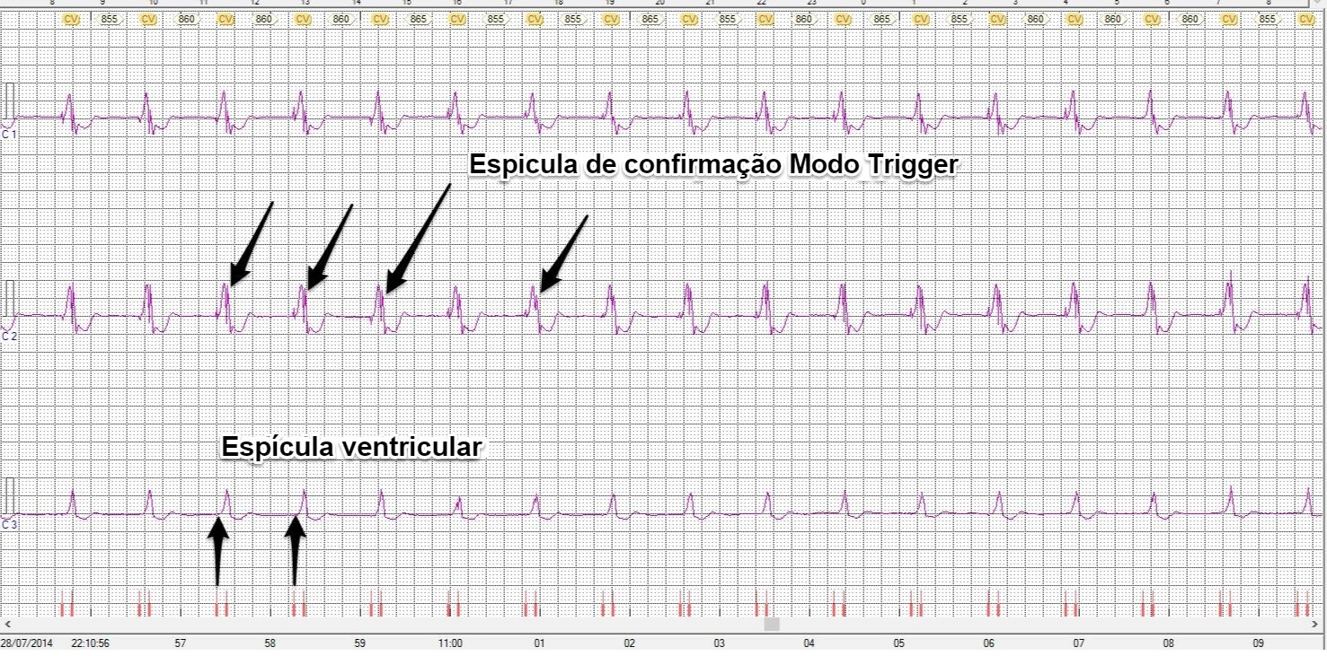 Marcapasso Modo Trigger - VVT - TME - Telemedicina Cardiológica