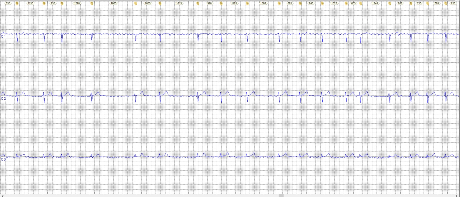 Flutter Atrial Atipico ou Incomum ou Fibrilo-Flutter - TME ...