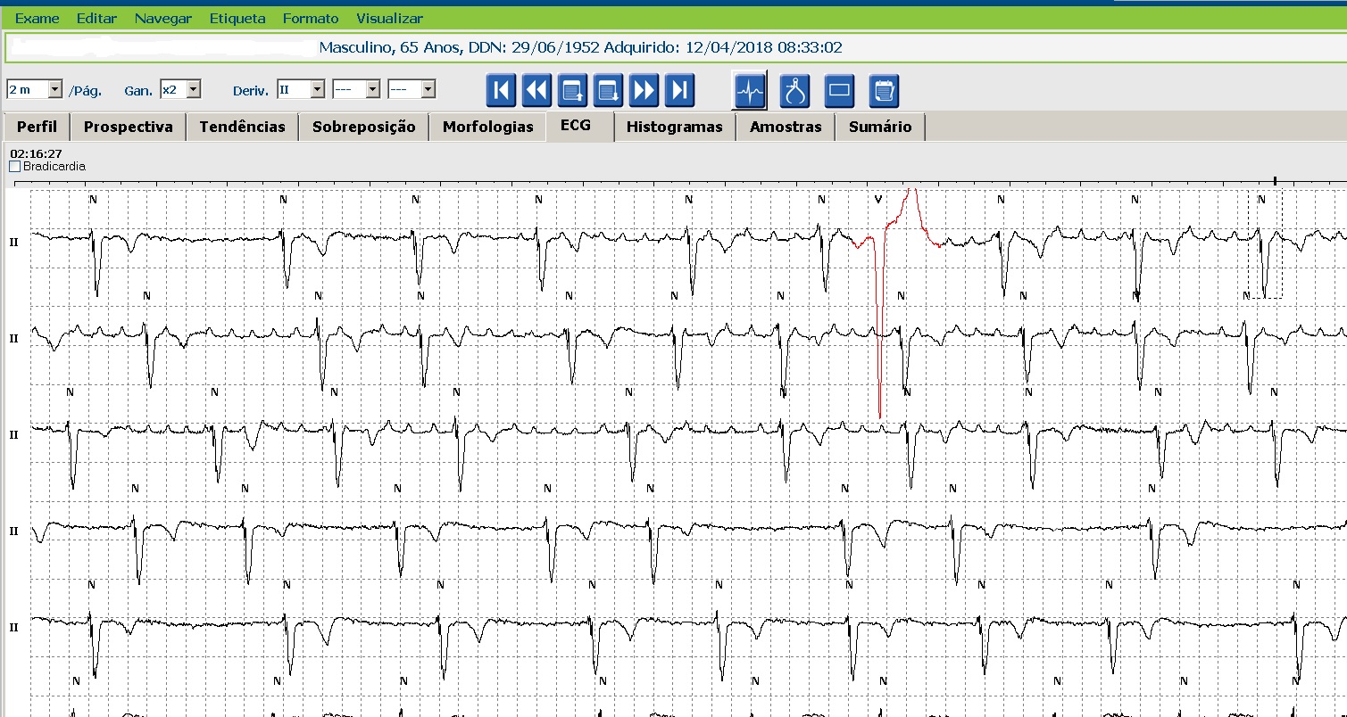 FIBRILO-FLUTTER - TME - Telemedicina Cardiológica