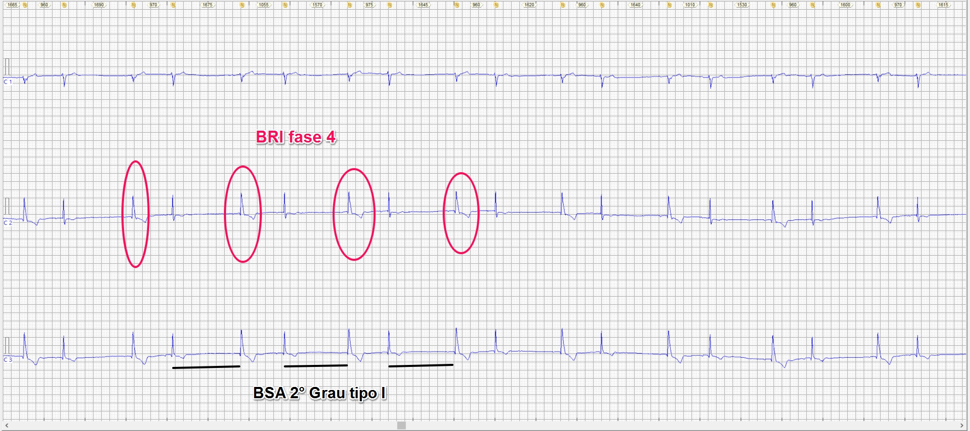 Bloqueio de Ramo Intermitente (BRI) Fase 4 Associado Bloqueio ...