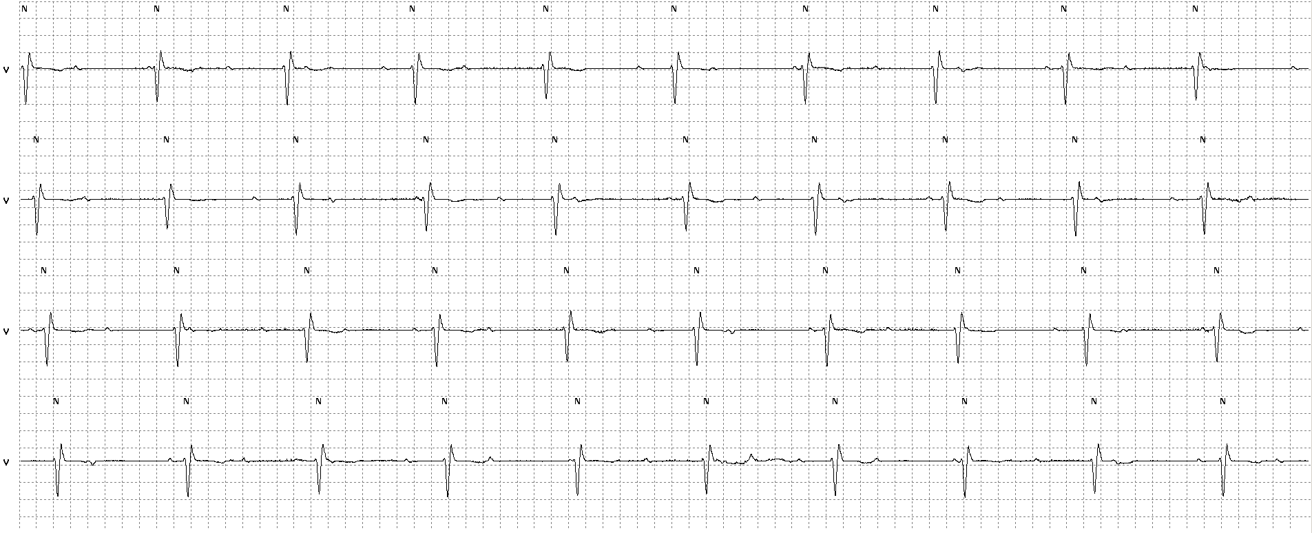 BAVT - Bloqueio atrioventricular total com QRS largo - TME ... BAVT - Bloqueio atrioventricular total com QRS largo - TME ...