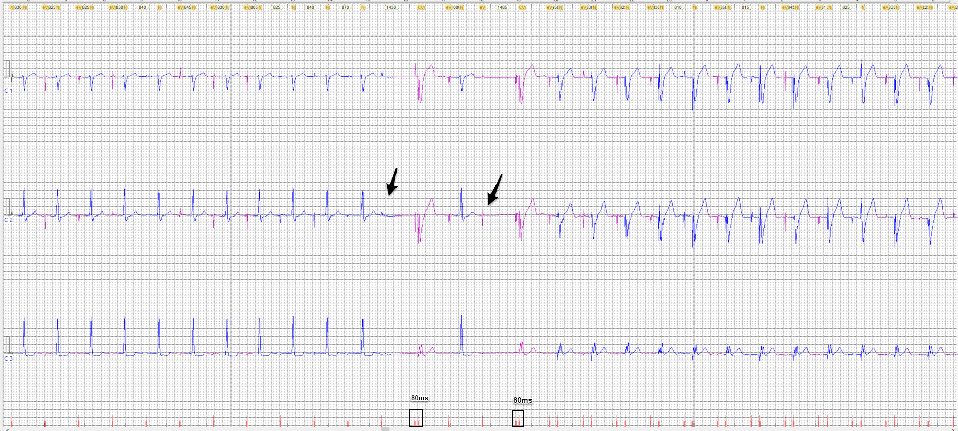 Managed Ventricular Pacing - Algoritmos especiais de programação ...