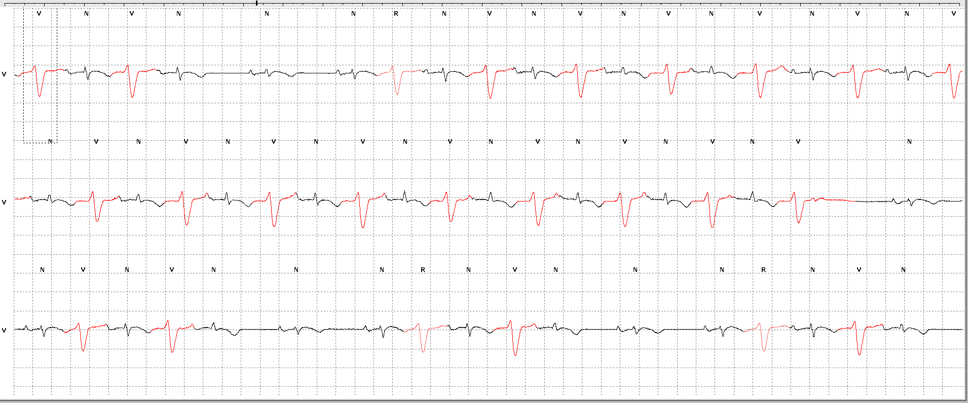 Bigeminismo ventricular interpolado - TME - Telemedicina Cardiológica